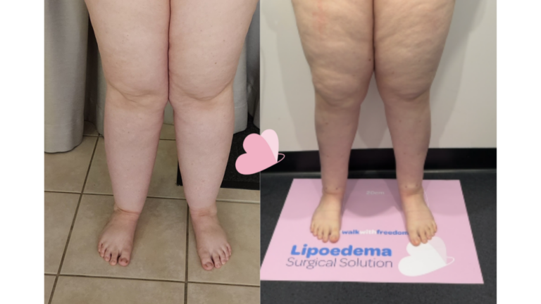 Abdominal Surgery – Lipoedema Surgical Solution